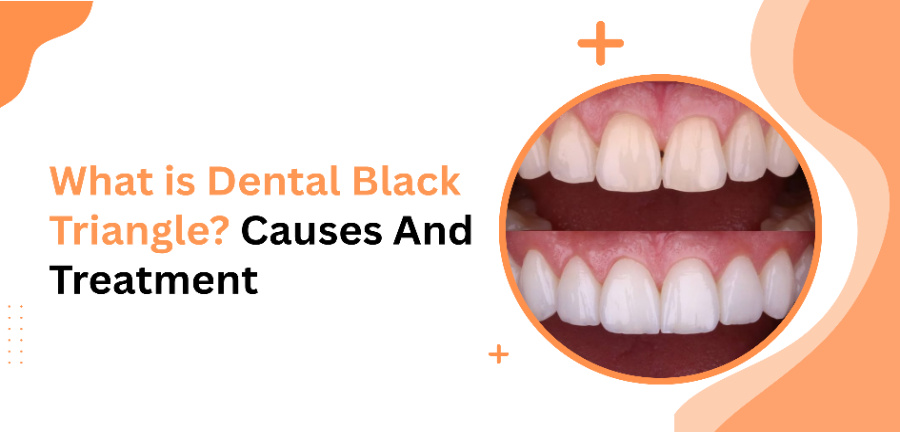 What is Dental Black Triangle? Causes and Treatment